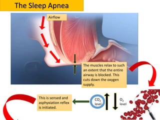 Sleep apnea | PPTX | Ear, Nose and Throat Conditions | Diseases and ...