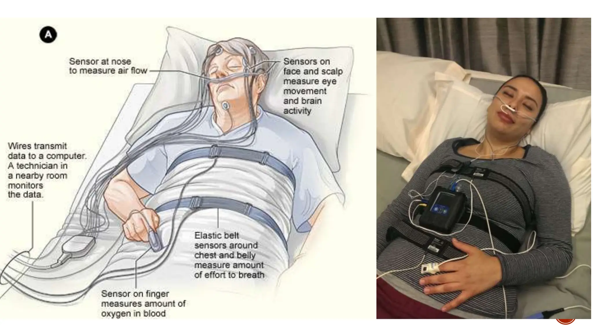 Types of sleep apnea and its management.pptx