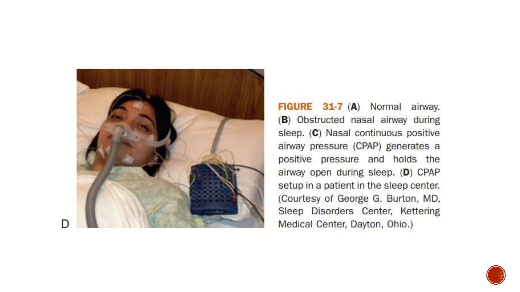 Types of sleep apnea and its management.pptx | Ear, Nose and Throat ...