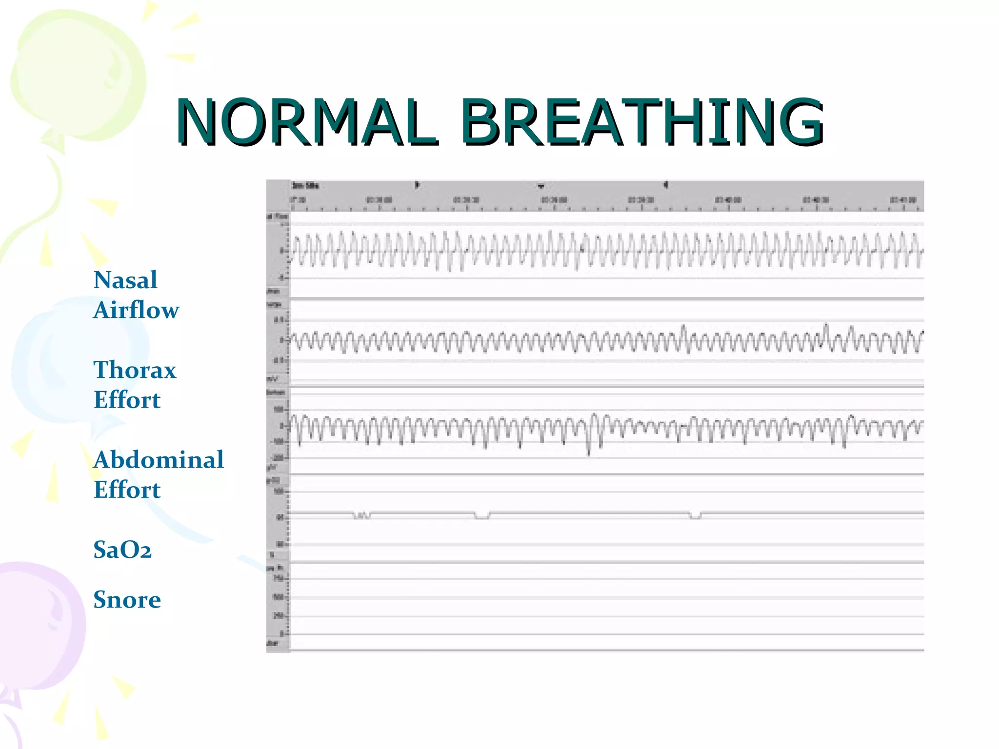 Sleep Disordered Breathing | PPT