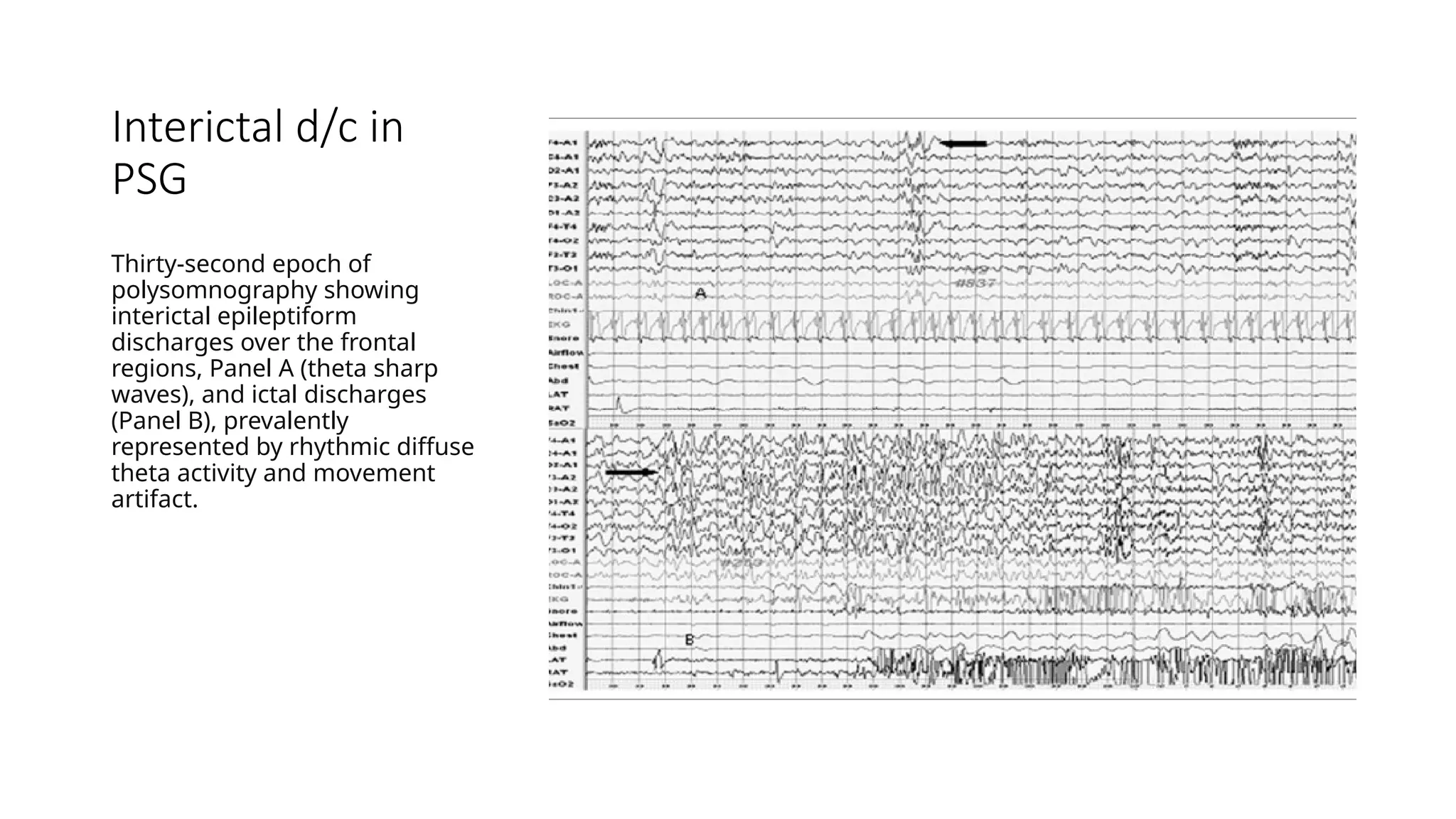Sleep in epilepsy - healthcare important | PPTX
