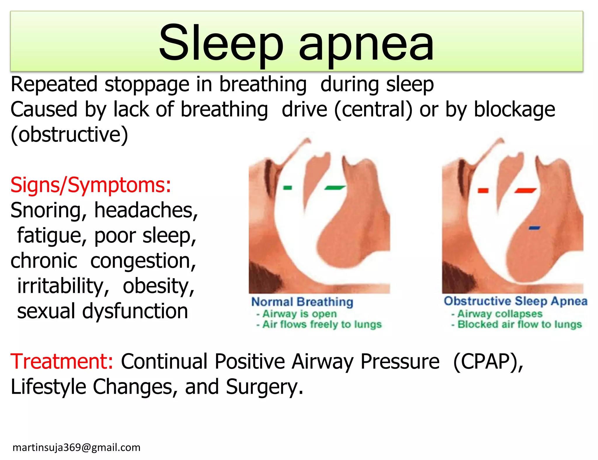 Sleep disorders - a brief medical study | PPTX
