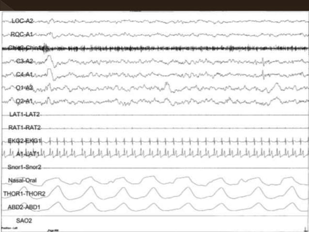 Sleep Scoring New.pptx