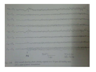 POLYSOMNOGRAPHY & EEG ACTIVATION METHODS | PPTX
