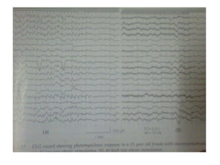 POLYSOMNOGRAPHY & EEG ACTIVATION METHODS | PPTX