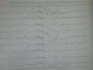 POLYSOMNOGRAPHY & EEG ACTIVATION METHODS | PPTX