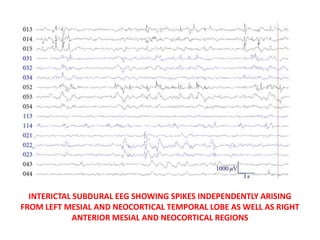POLYSOMNOGRAPHY & EEG ACTIVATION METHODS | PPTX