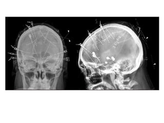 POLYSOMNOGRAPHY & EEG ACTIVATION METHODS | PPTX