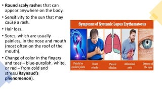 SYSTEMIC LUPUS ERYTHEMATOUS | PPTX | Blood Disorders | Diseases and ...