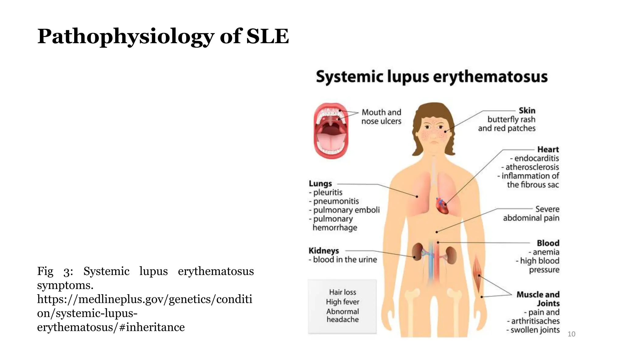 Systemic lupus erythematosus (SLE) disease | PPTX