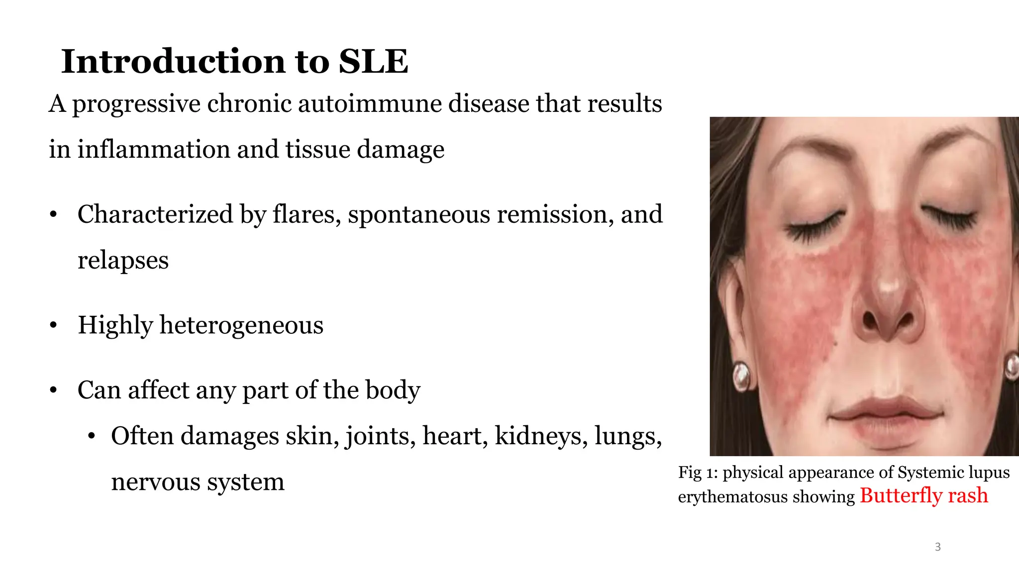 Systemic lupus erythematosus (SLE) disease | PPTX
