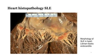 Systemic lupus erythematosus (SLE) disease | PPTX