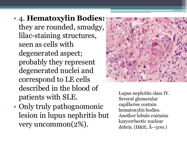 Sle & kidney