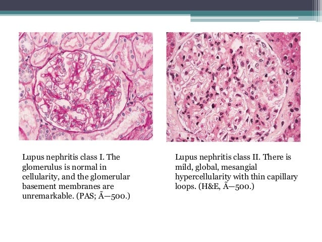 Sle & kidney