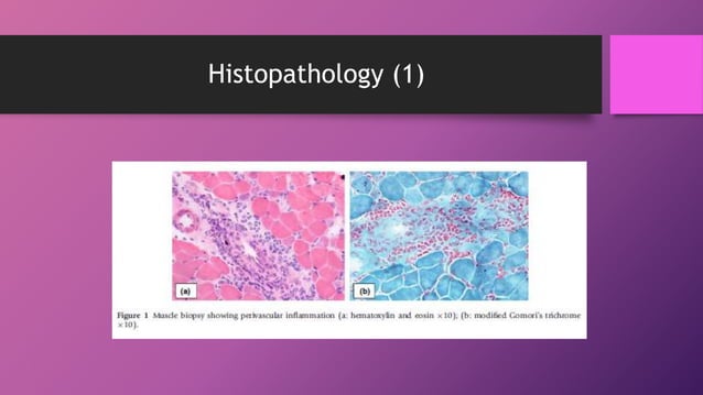 SLE Myopathy | PPTX | Physical Therapy | Wellness