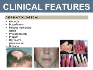 SLE.pptx | Skin and Dermatology | Diseases and Conditions