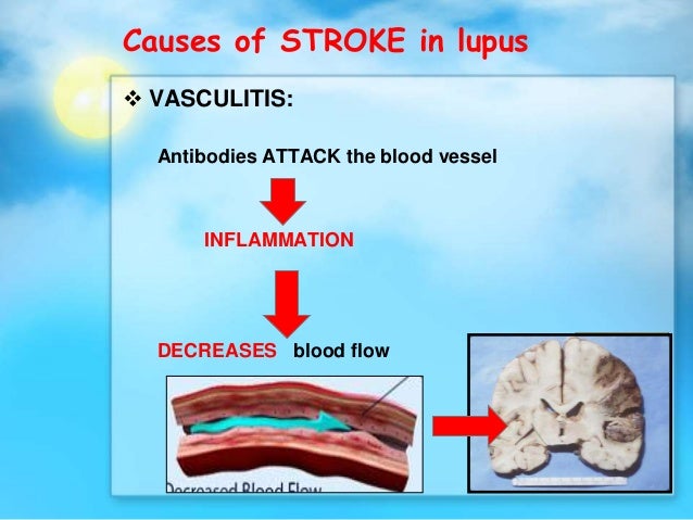 Sle and stroke for lupeans