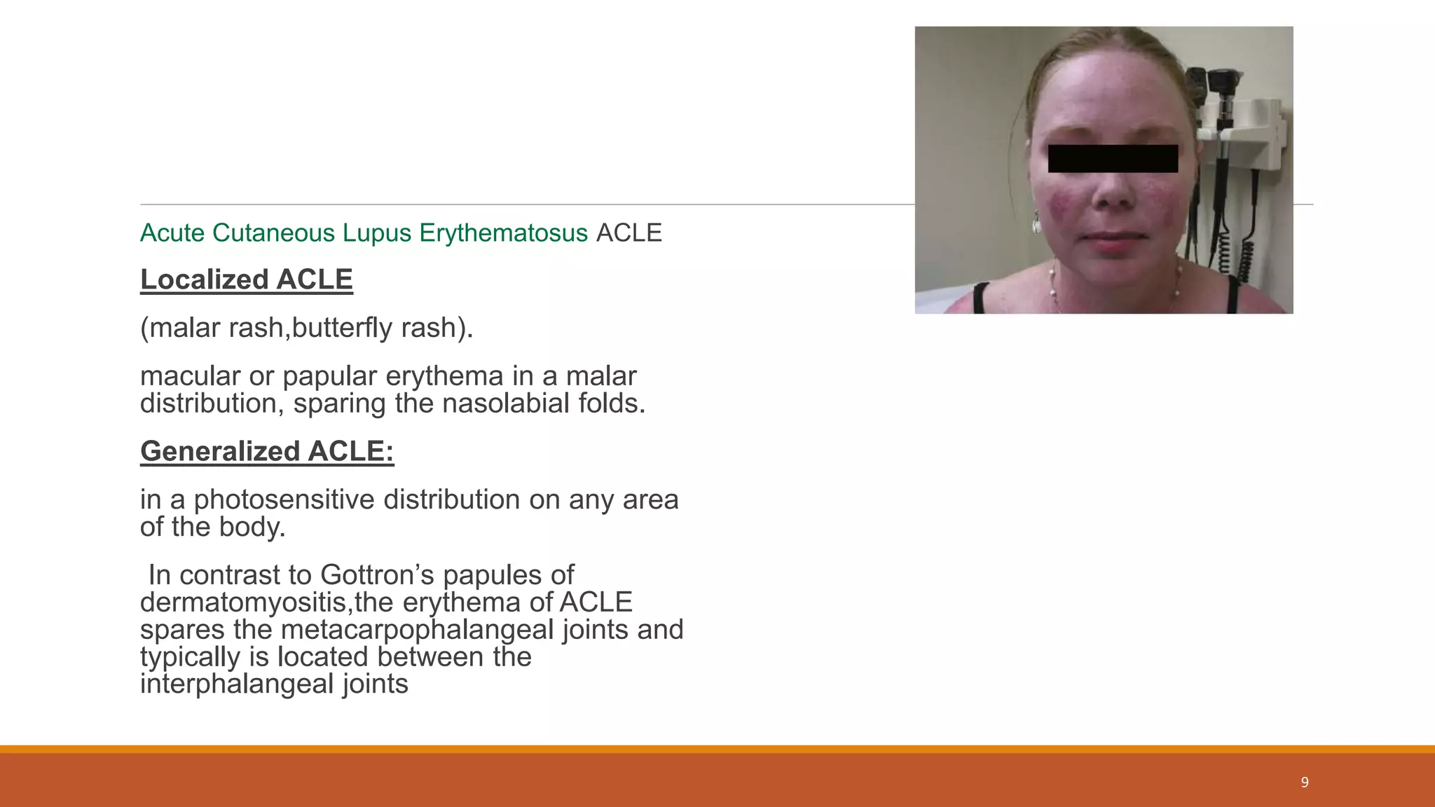 SLE Systemic lupus erythematosus basics 2022 Prof. Hanan Ali Taha | PPTX