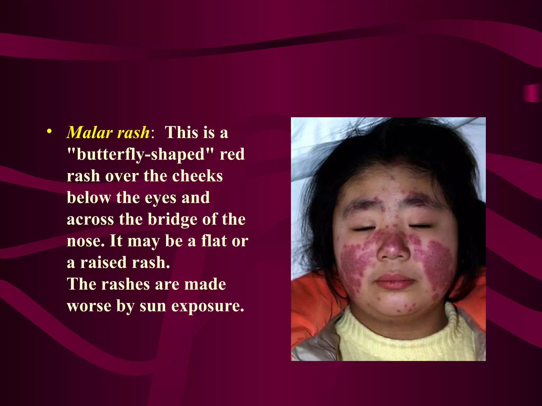 systemic lupus erythematosus | PPT