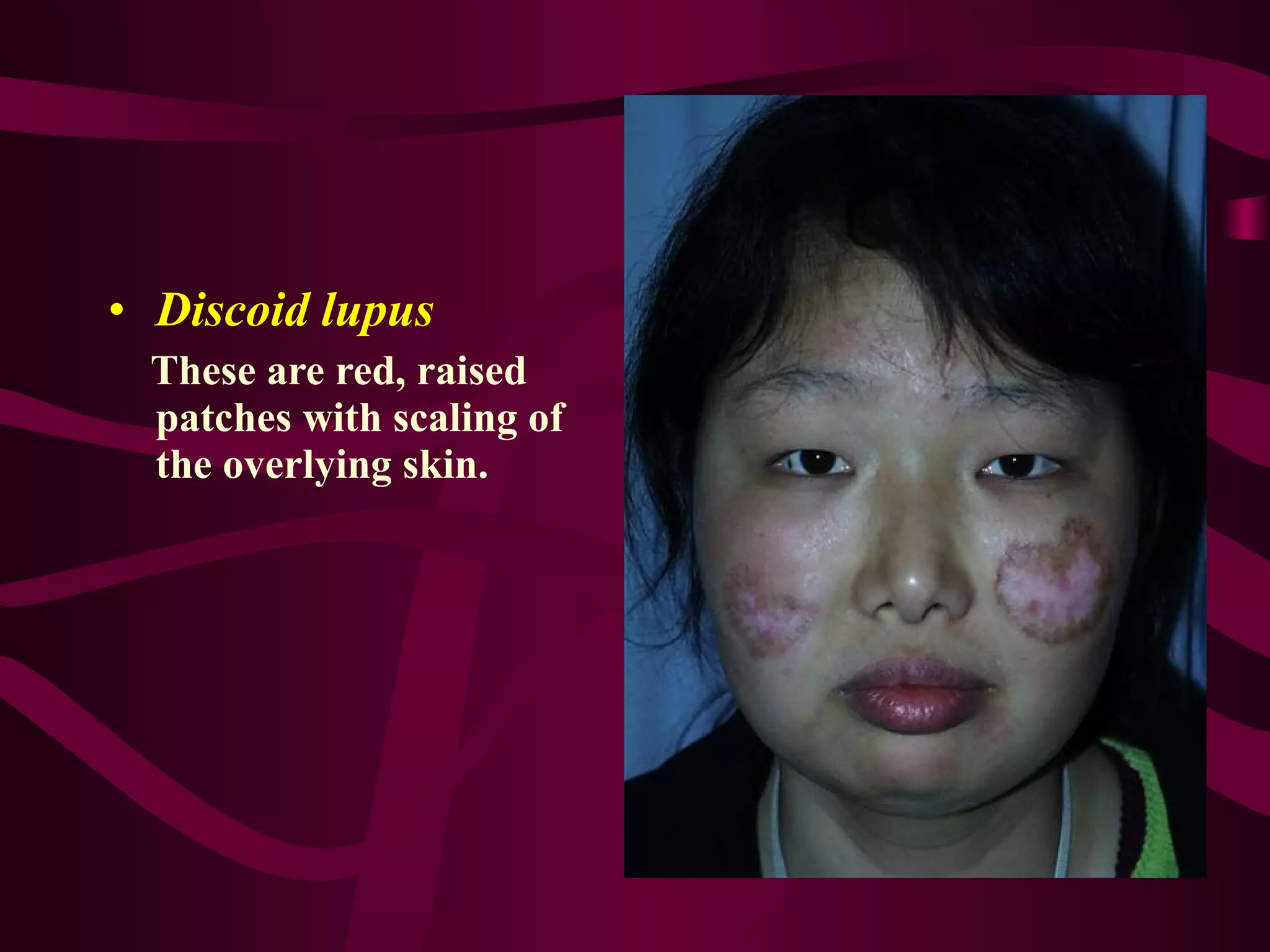 systemic lupus erythematosus | PPT