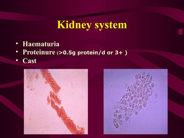 systemic lupus erythematosus | PPT