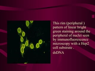 systemic lupus erythematosus | PPT