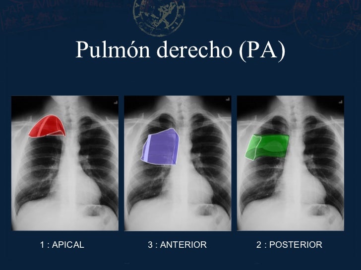 Anatomía del tórax por radiografía simple