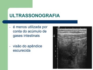 Slide apendicectomia. | PPTX
