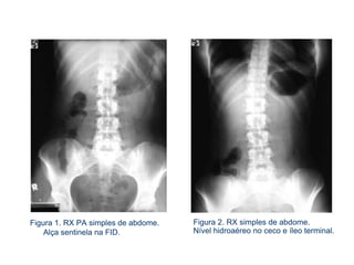 Slide apendicectomia. | PPT
