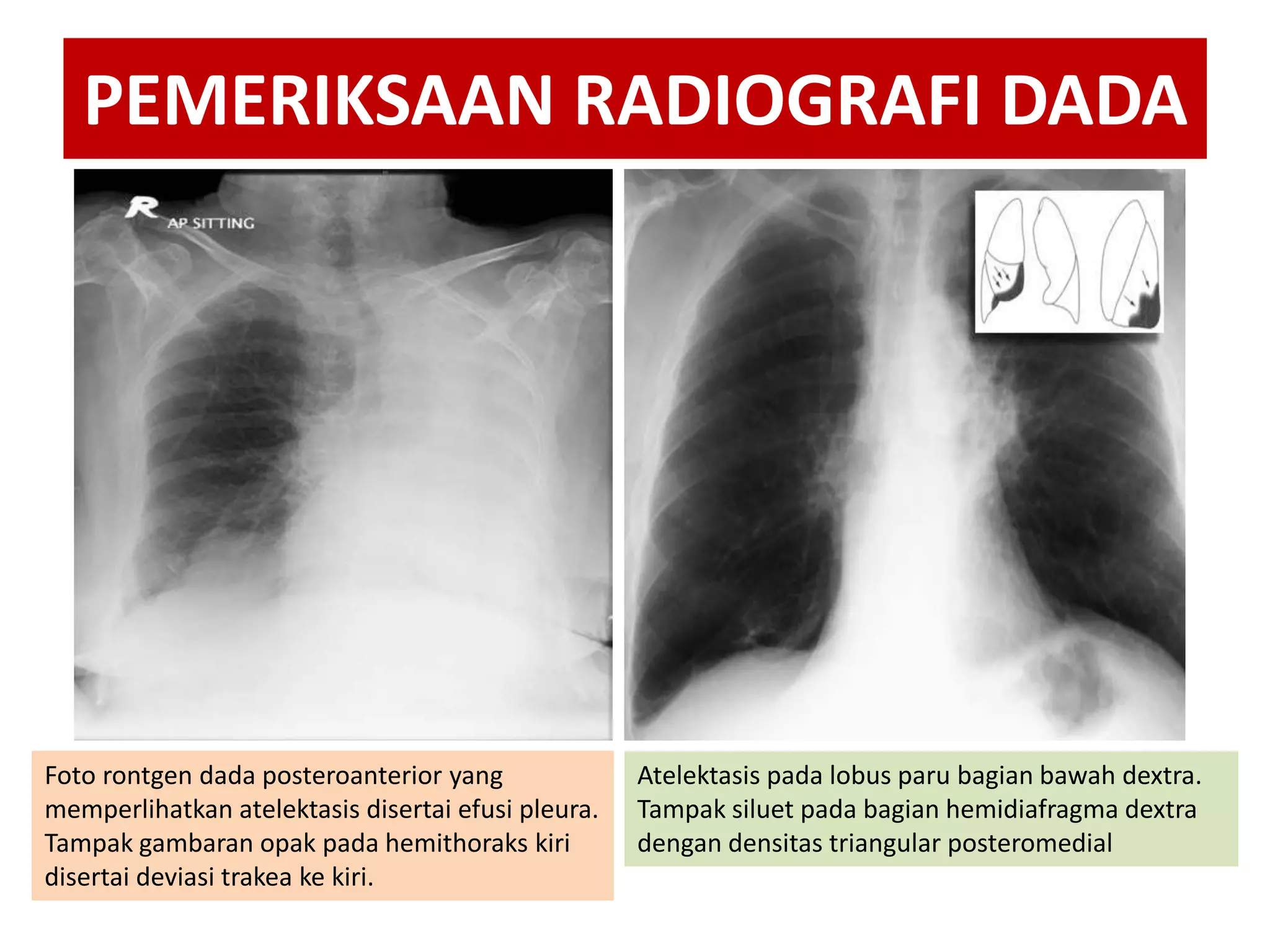 Slide atelektasis paru | PPTX