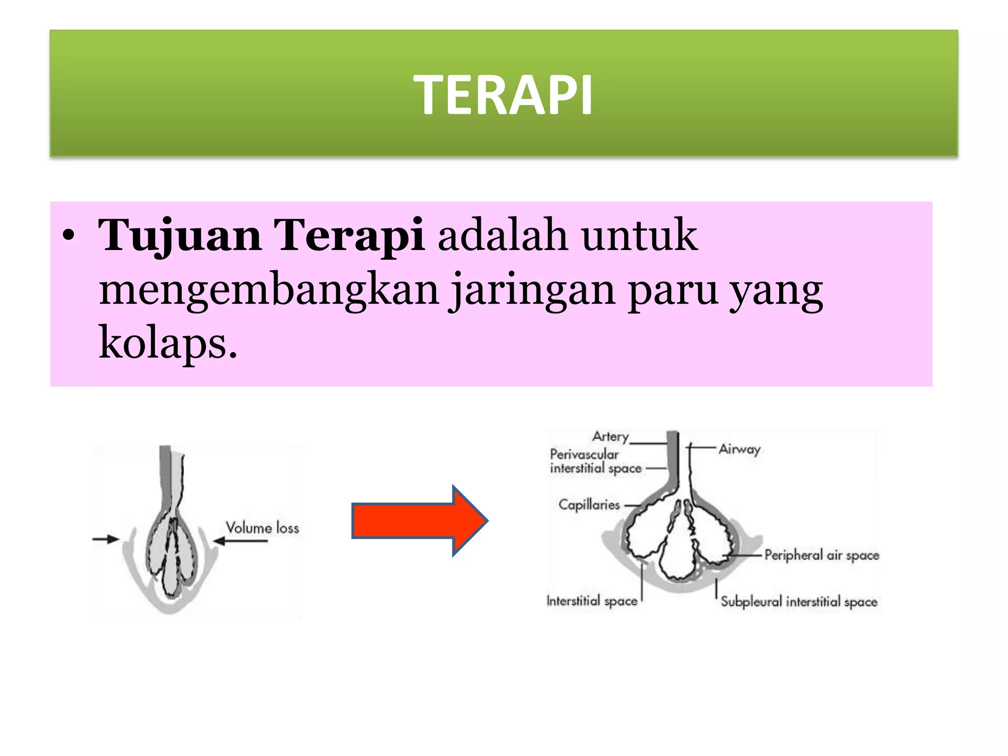 Slide atelektasis paru | PPTX