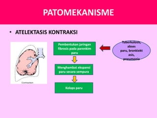 Slide atelektasis paru | PPTX
