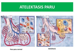 Slide atelektasis paru | PPTX