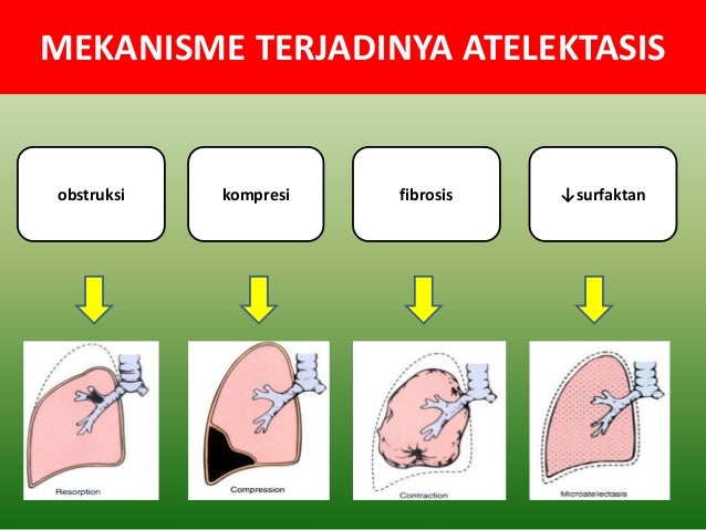 Slide atelektasis paru