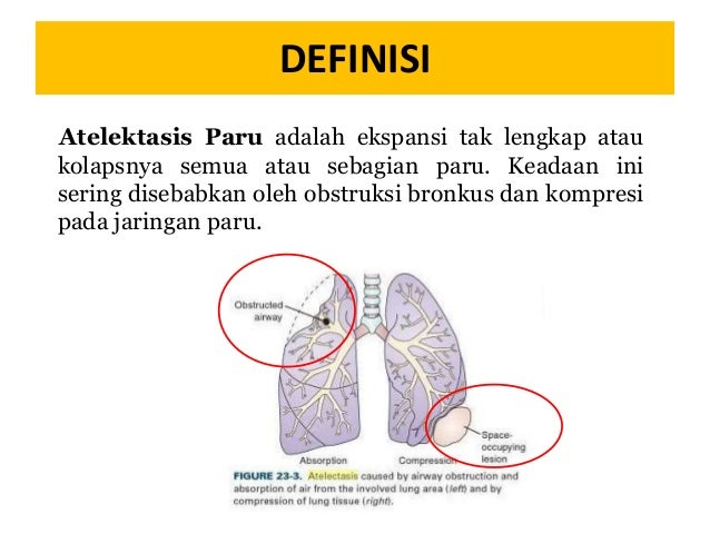 Slide atelektasis paru