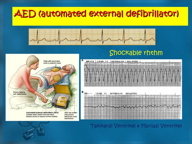 Slide defibrilator | PPT