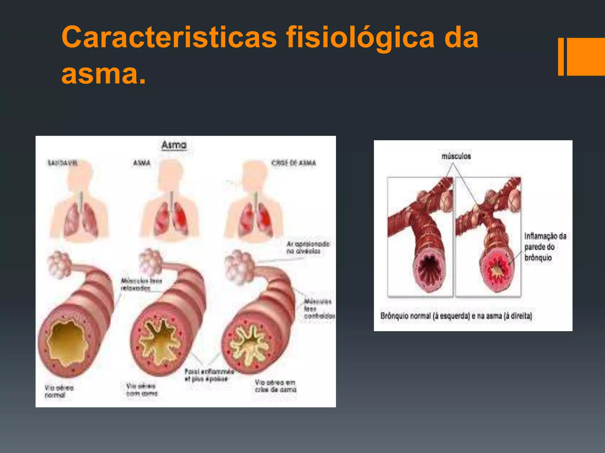 Asma,bronquite,rinite e sinusite.Seus aspecto fisiológico | PPT