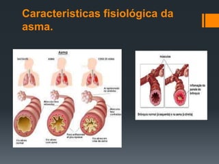 Asma,bronquite,rinite e sinusite.Seus aspecto fisiológico | PPTX