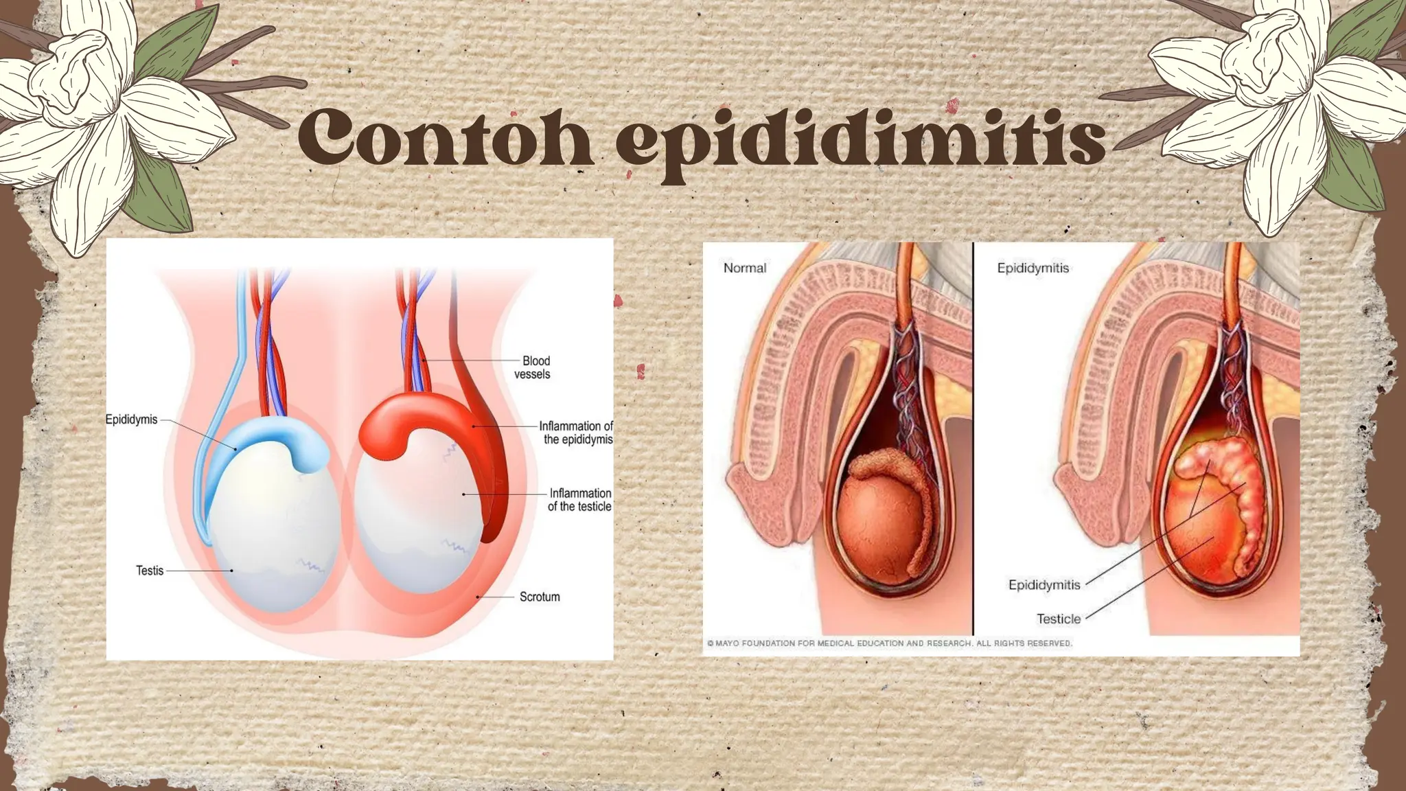 SLIDE PRESENTATION EPIDIDIMITIS (GROUP 5) | PPT