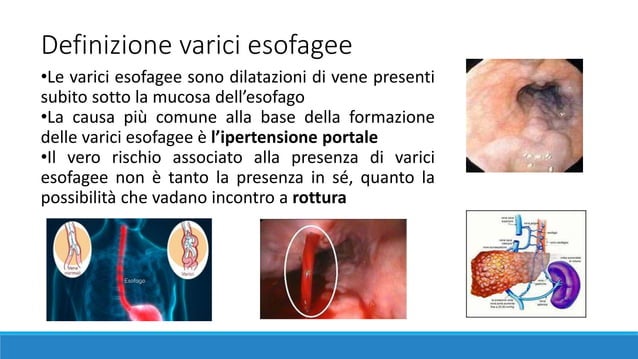 Diagnosi e terapia endoscopica delle varici esofagee e gastriche