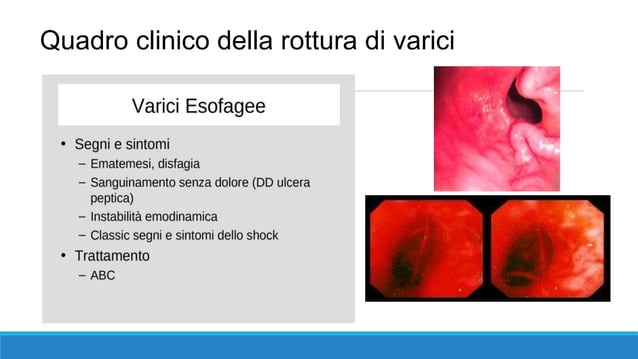 Diagnosi e terapia endoscopica delle varici esofagee e gastriche