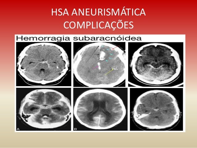HEMORRAGIA SUBARACNOIDEA
