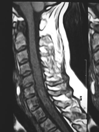Slide show...Intramedullary cystic spinal cord metastasis | PDF