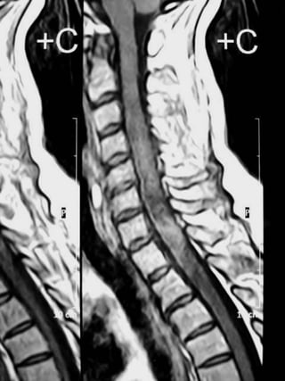 Slide show...Intramedullary cystic spinal cord metastasis | PDF