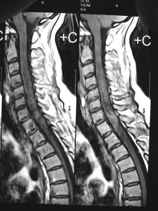 Slide show...Intramedullary cystic spinal cord metastasis | PDF