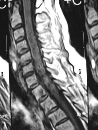Slide show...Intramedullary cystic spinal cord metastasis | PDF