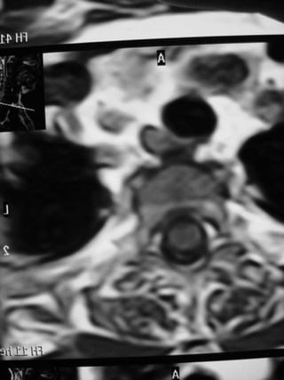 Slide show...Intramedullary cystic spinal cord metastasis | PDF