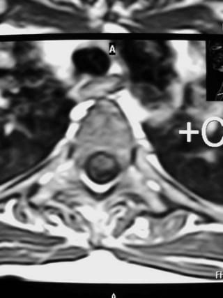 Slide show...Intramedullary cystic spinal cord metastasis | PDF