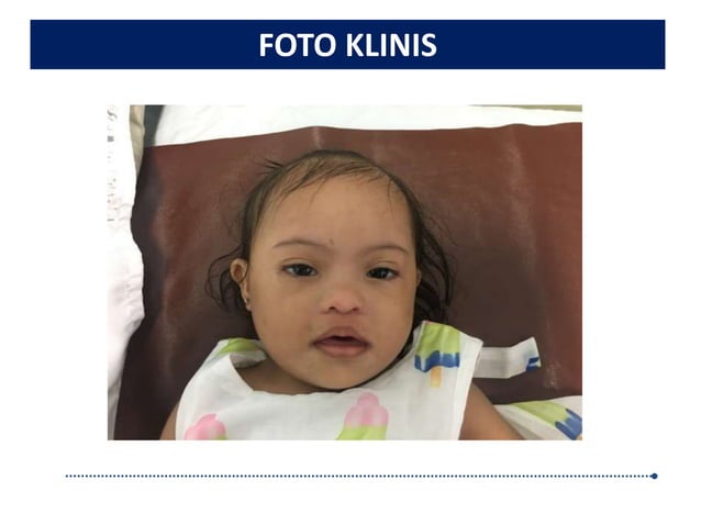 SLIDE lapkas Sindrom Down.ppt