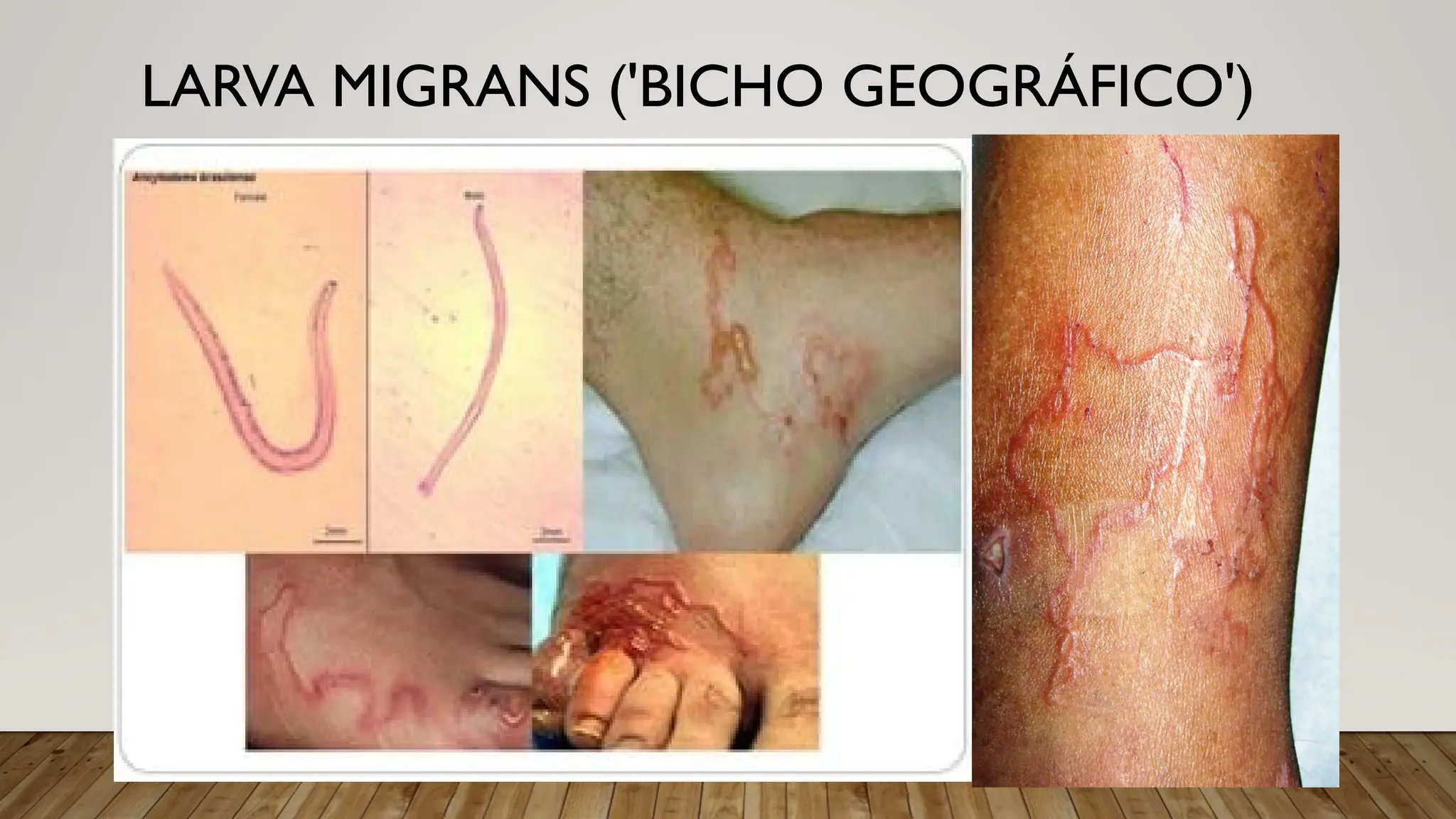 A larva migrans cutânea, conhecida popularmente por bicho geográfico | PPT